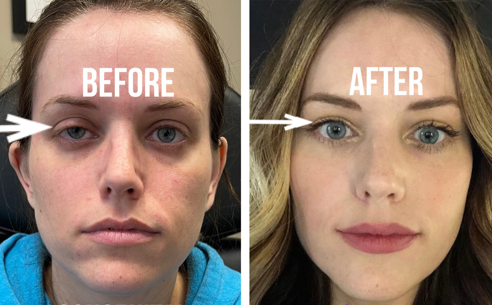 Ptosis Correction in Surat - Callisto Clinic