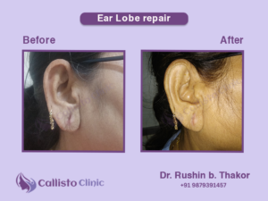 Ear Repair Surgery - Callisto Clinic